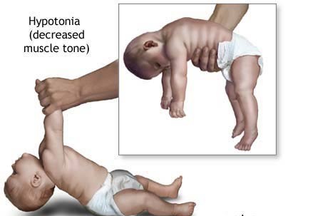 Physiotherapy management of hypotonia (2) - Graphic Online